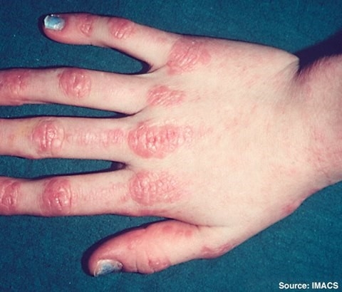 Les papules de Gottron liées à la dermatomyosite - Groupe d'Intérêt ...